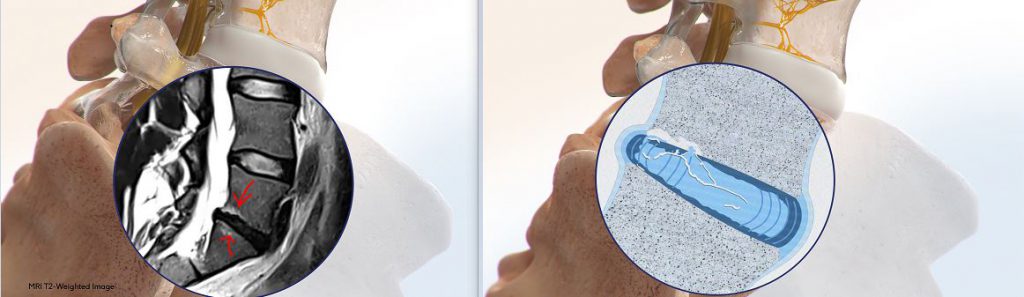 Intracept Procedure – Lowell Pain Center